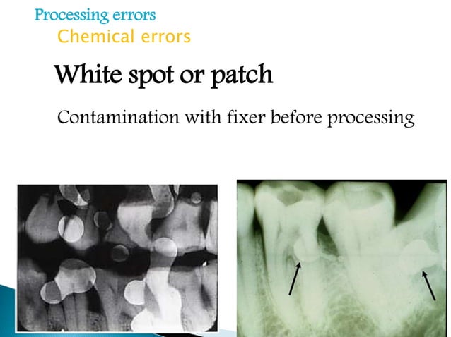 Errors of dental radiography | PPTX