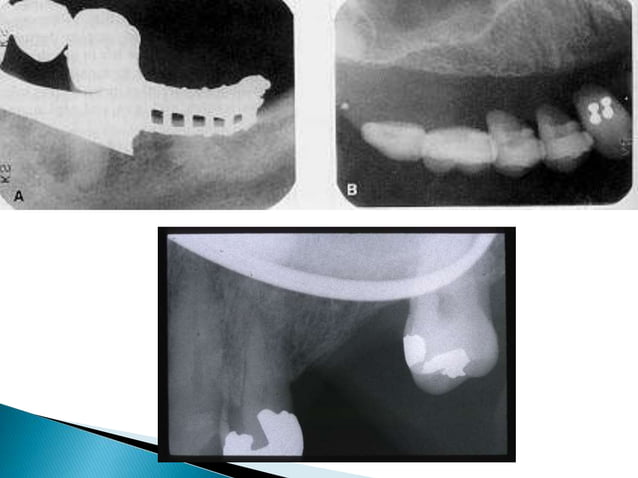 Errors of dental radiography | PPTX
