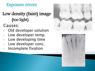 Radiographic In Dental Radiography Errors