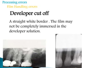 Radiographic In Dental Radiography Errors