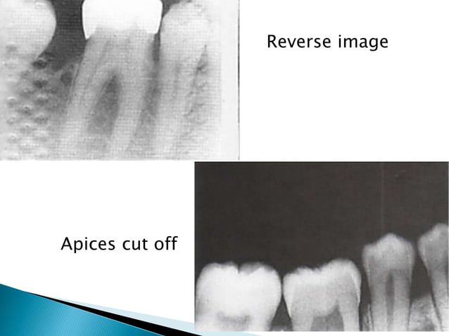 Errors of dental radiography