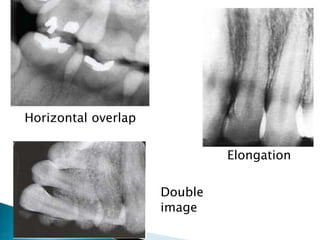 Radiographic In Dental Radiography Errors