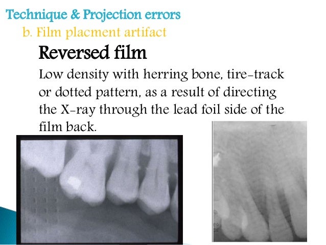 Errors of dental radiography