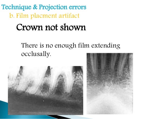 Errors of dental radiography