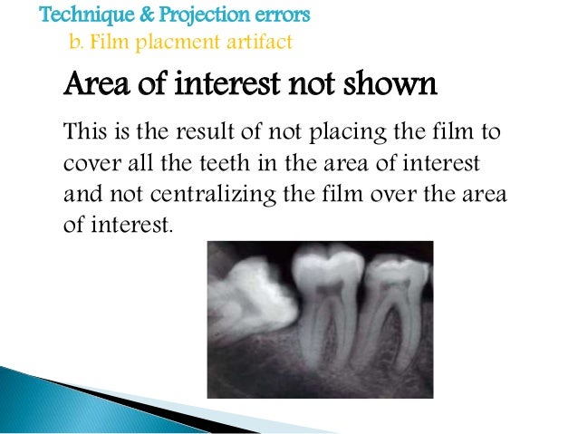 Errors of dental radiography