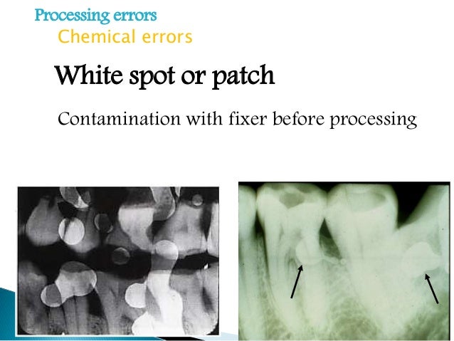 Errors of dental radiography