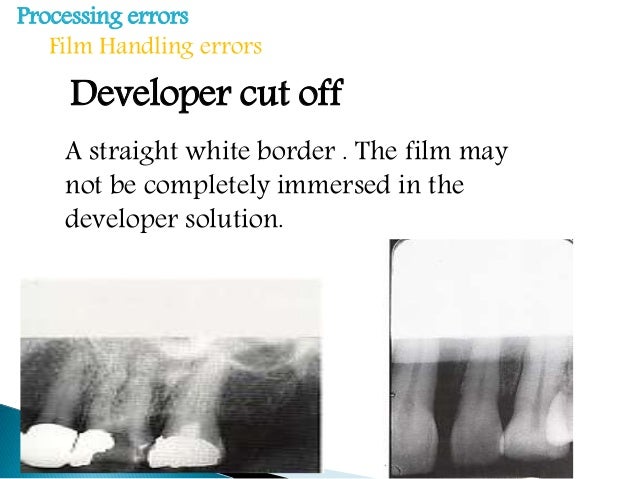 Errors of dental radiography