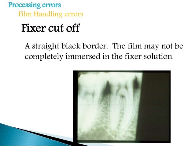 Errors of dental radiography