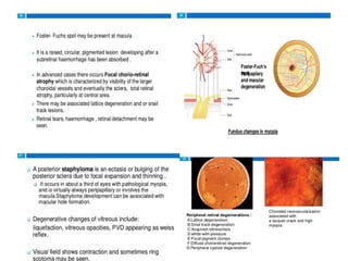 Errors of refraction | PPTX