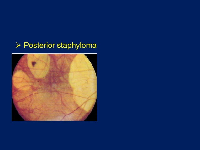 errorsofrefraction-200824062323.pptx