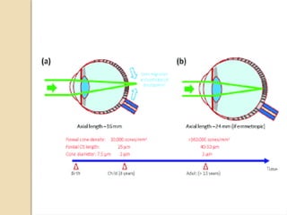 ERRORS OF REFRACTION AND BINOCULAR OPTIC DEFECTS.pptx