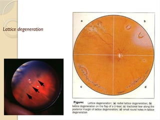ERRORS OF REFRACTION AND BINOCULAR OPTIC DEFECTS.pptx