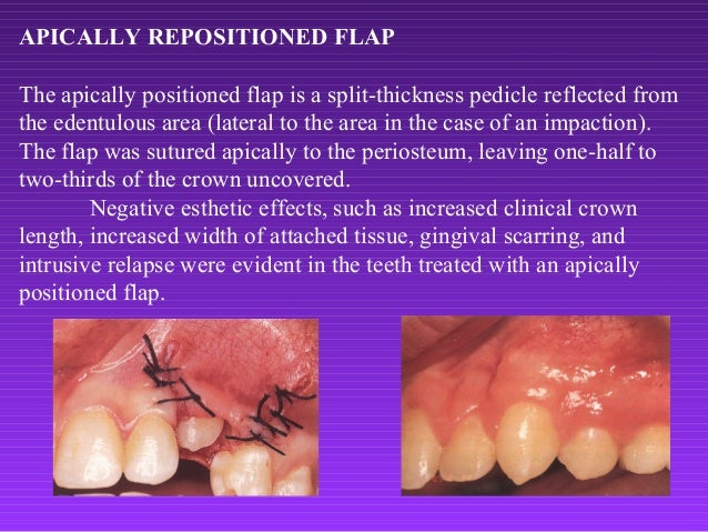 Erruptive abnormalities and their rx