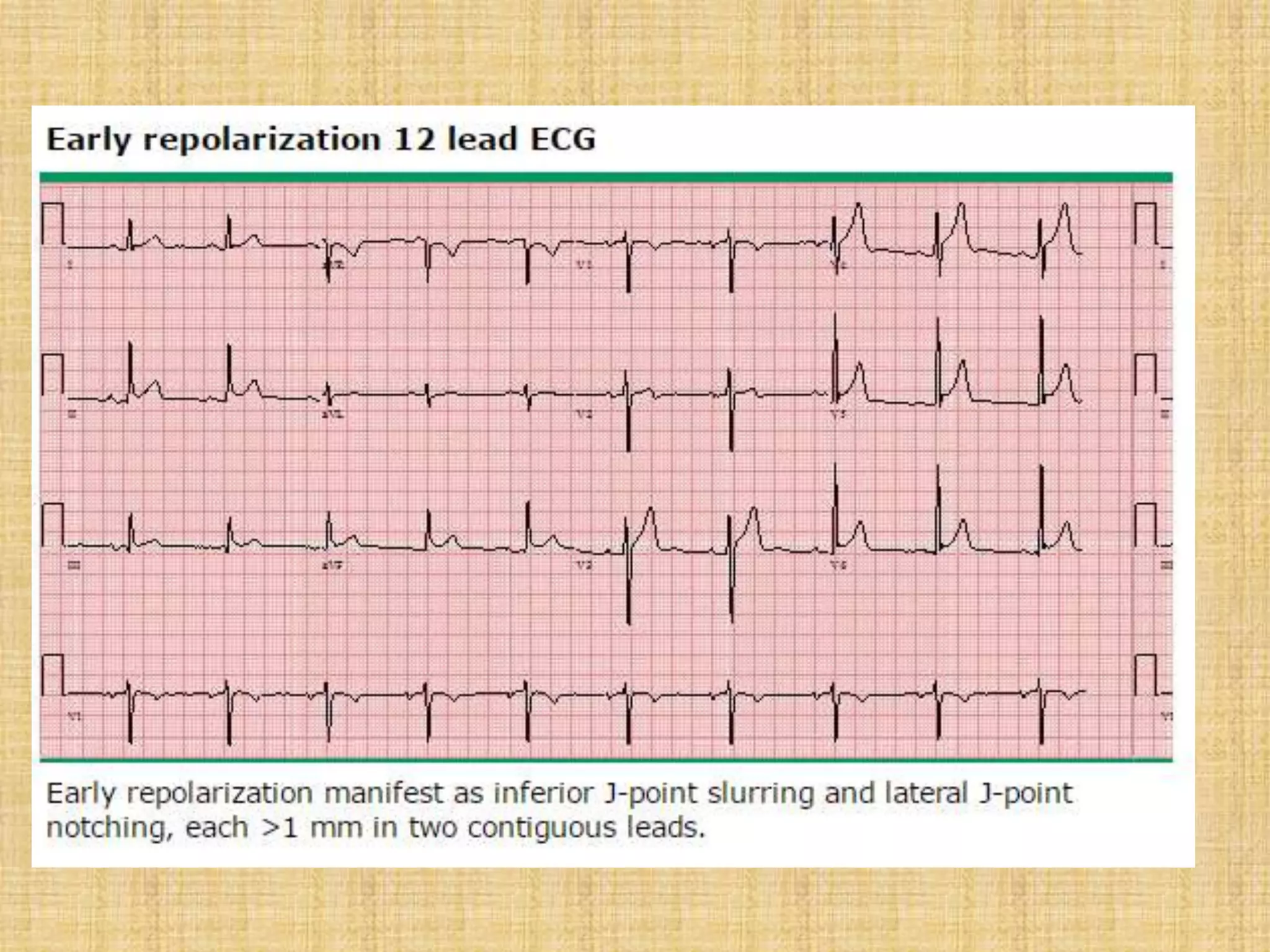 Early repolarisation syndrome | PPTX