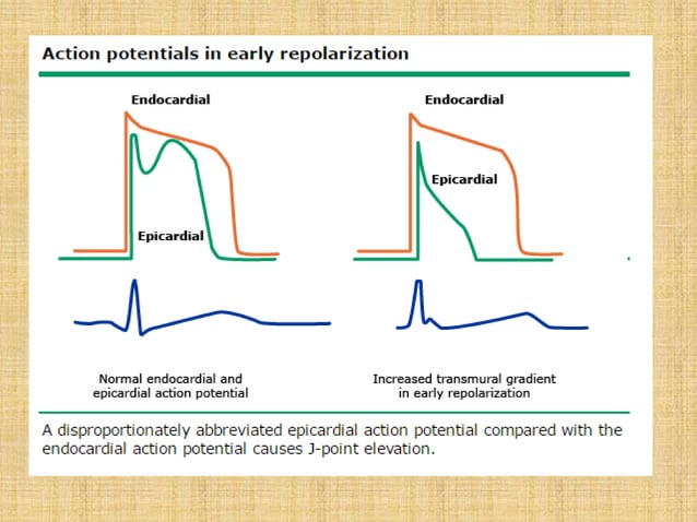 Early repolarisation syndrome | PPTX | Heart and Cardiovascular ...