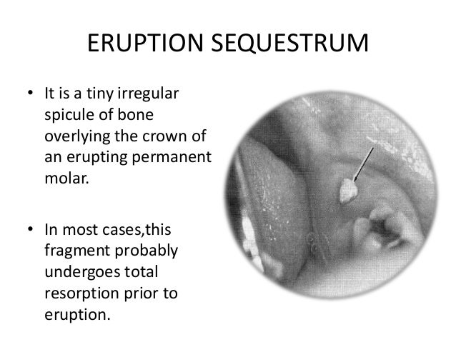 Deciduous and permanent teeth Eruption time and shedding
