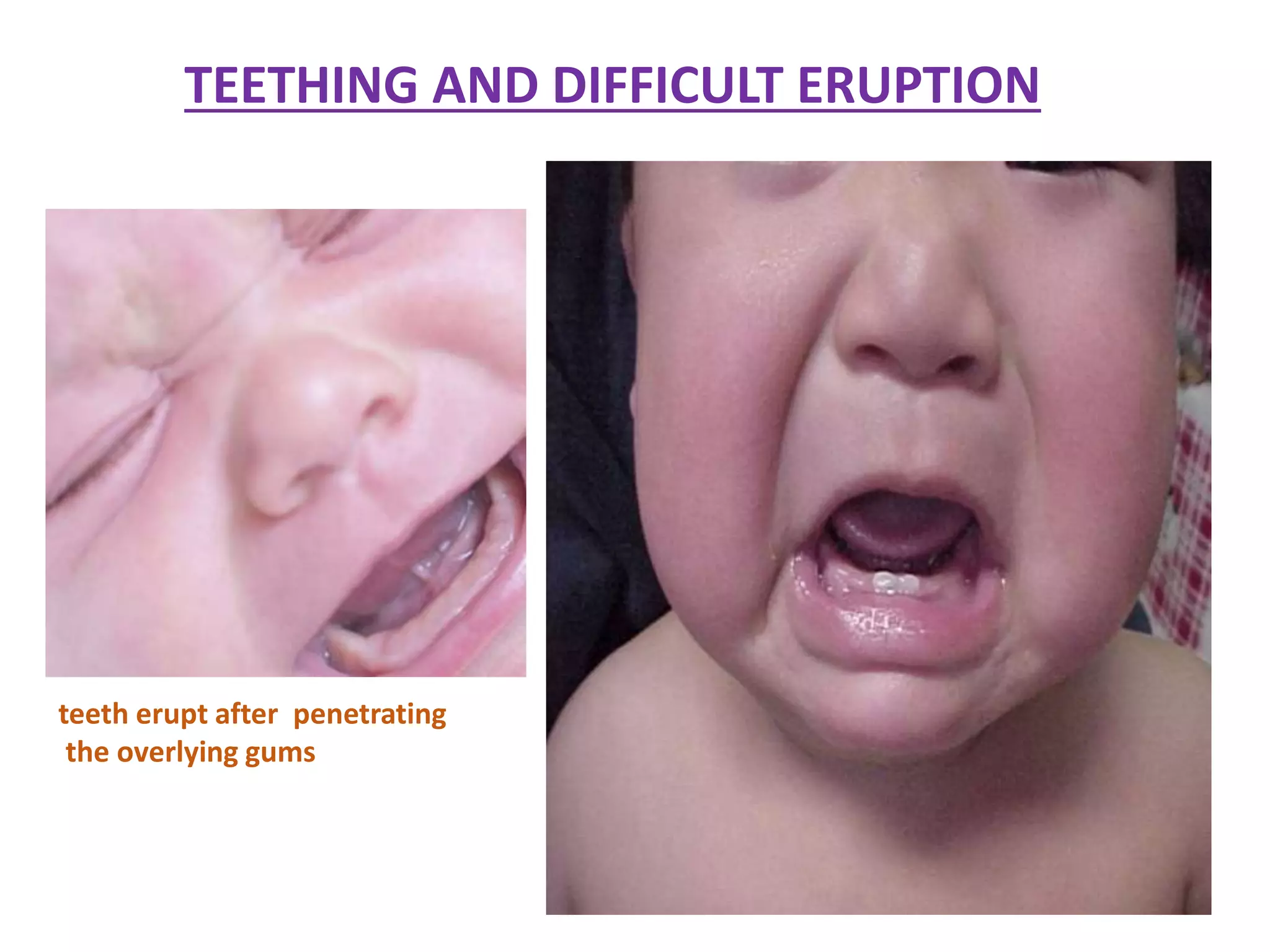 ERUPTION AND SHEDDING-CLINICAL ASPECTS | PPTX