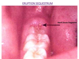 ERUPTION AND SHEDDING-CLINICAL ASPECTS | PPTX
