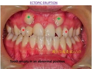 ERUPTION AND SHEDDING-CLINICAL ASPECTS | PPTX