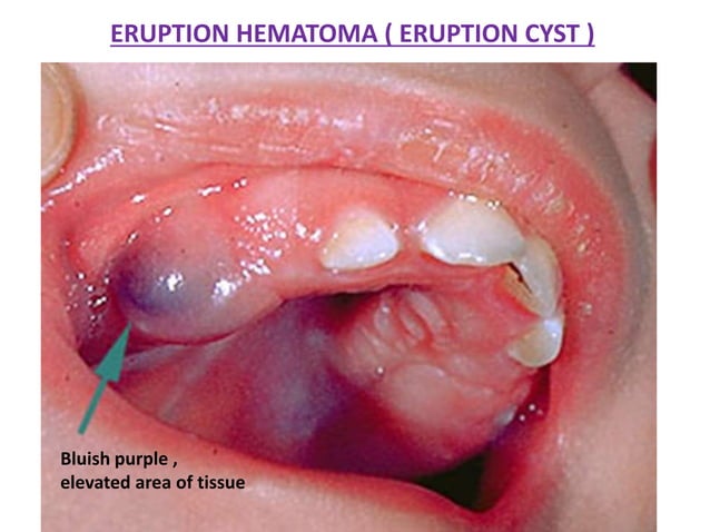 ERUPTION AND SHEDDING-CLINICAL ASPECTS | PPTX