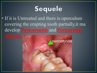 Eruption gingivitis and pericoronitis in children | PPTX