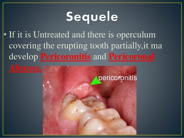 Eruption gingivitis and pericoronitis in children