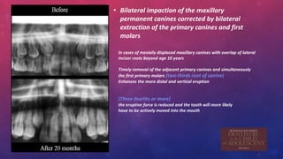 Eruption guidance of the developing dentition.pptx | Dental Health ...