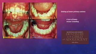 Eruption guidance of the developing dentition.pptx | Dental Health ...