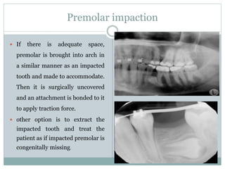Eruptive abnormaities in orthodontic movement | PPTX