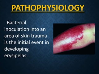 ERYSIPELAS.pptx