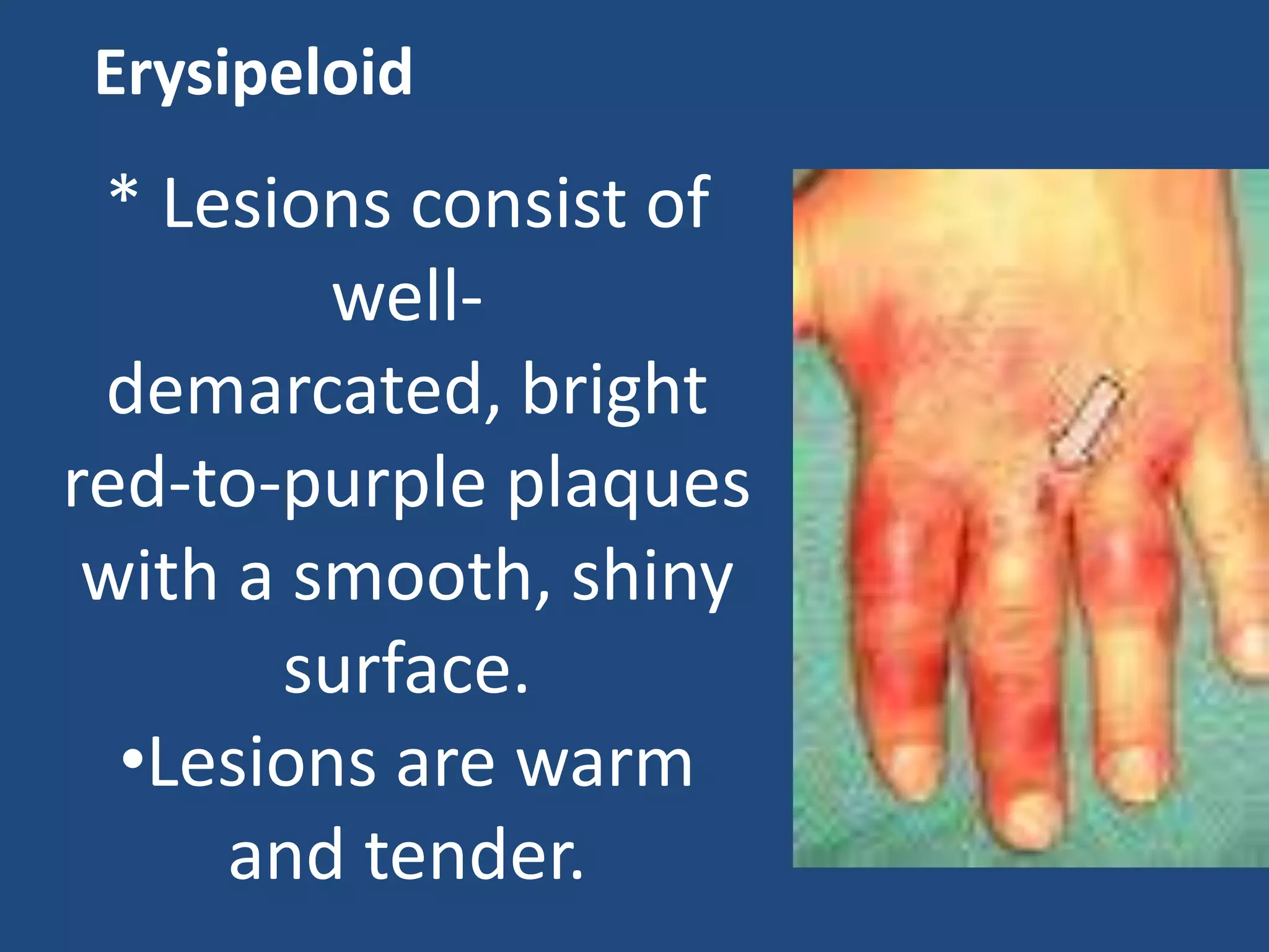 Erysipelas | PPTX