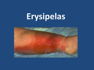 Erysipelas Children