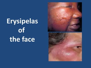 Erysipelas Pediatric