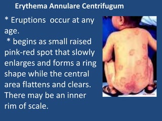 Erysipelas Pediatric