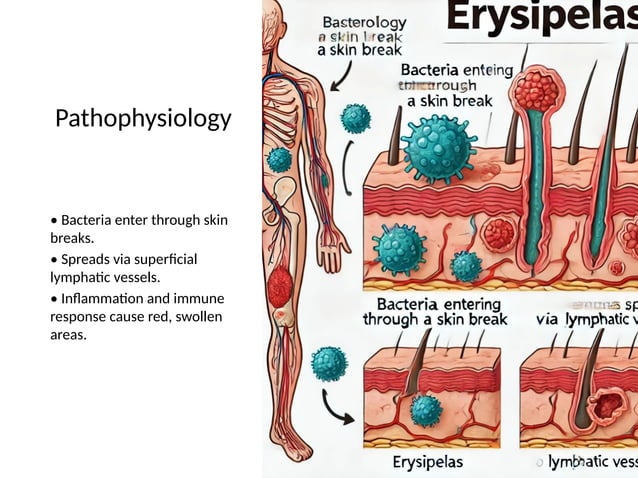 Erysipelas_Etiology_and_Epidemiology_Presentation.pptx | Skin and ...