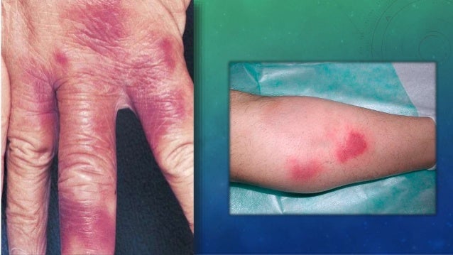 Erysipelothrix rhusiopathiae (ERISIPELA PORCINA)