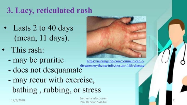 Erythema infectiosum (fifth disease) | PPT