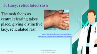 Erythema infectiosum (fifth disease) | PPT