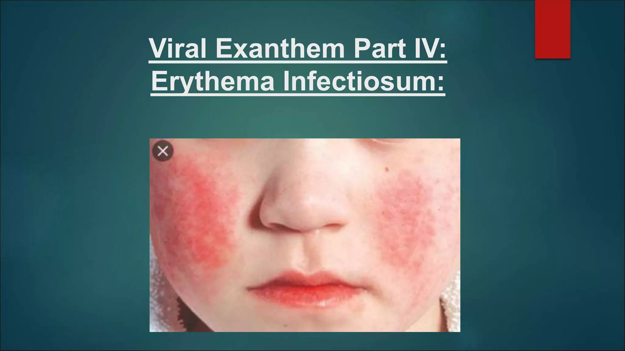 Erythema infectiosum made Very simple!!!!!! | PPT