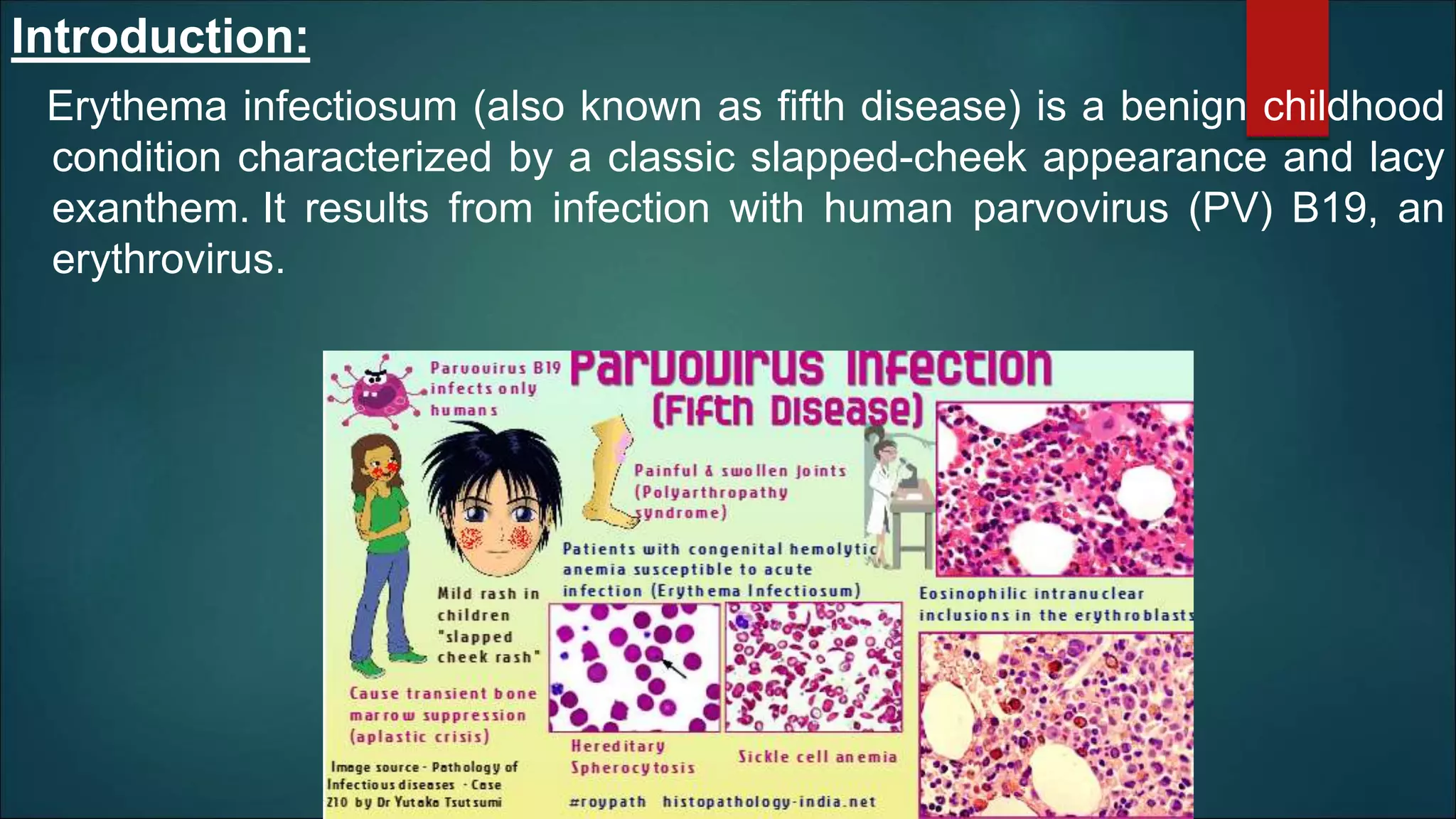 Erythema infectiosum made Very simple!!!!!! | PPT