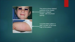 Erythema infectiosum made Very simple!!!!!! | PPT