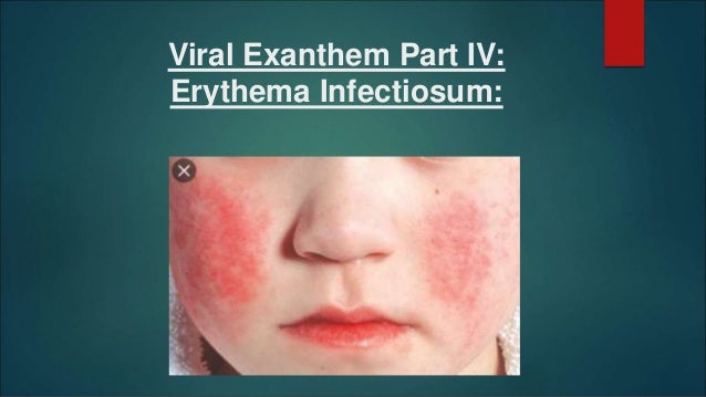 Erythema infectiosum made Very simple!!!!!!