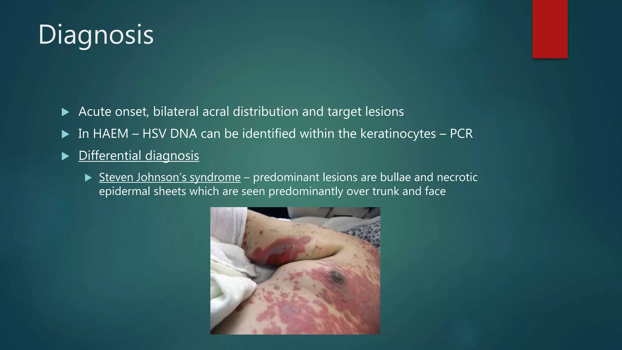 Erythema multiforme | PPTX