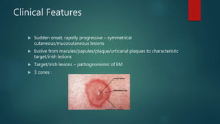 Erythema multiforme | PPTX
