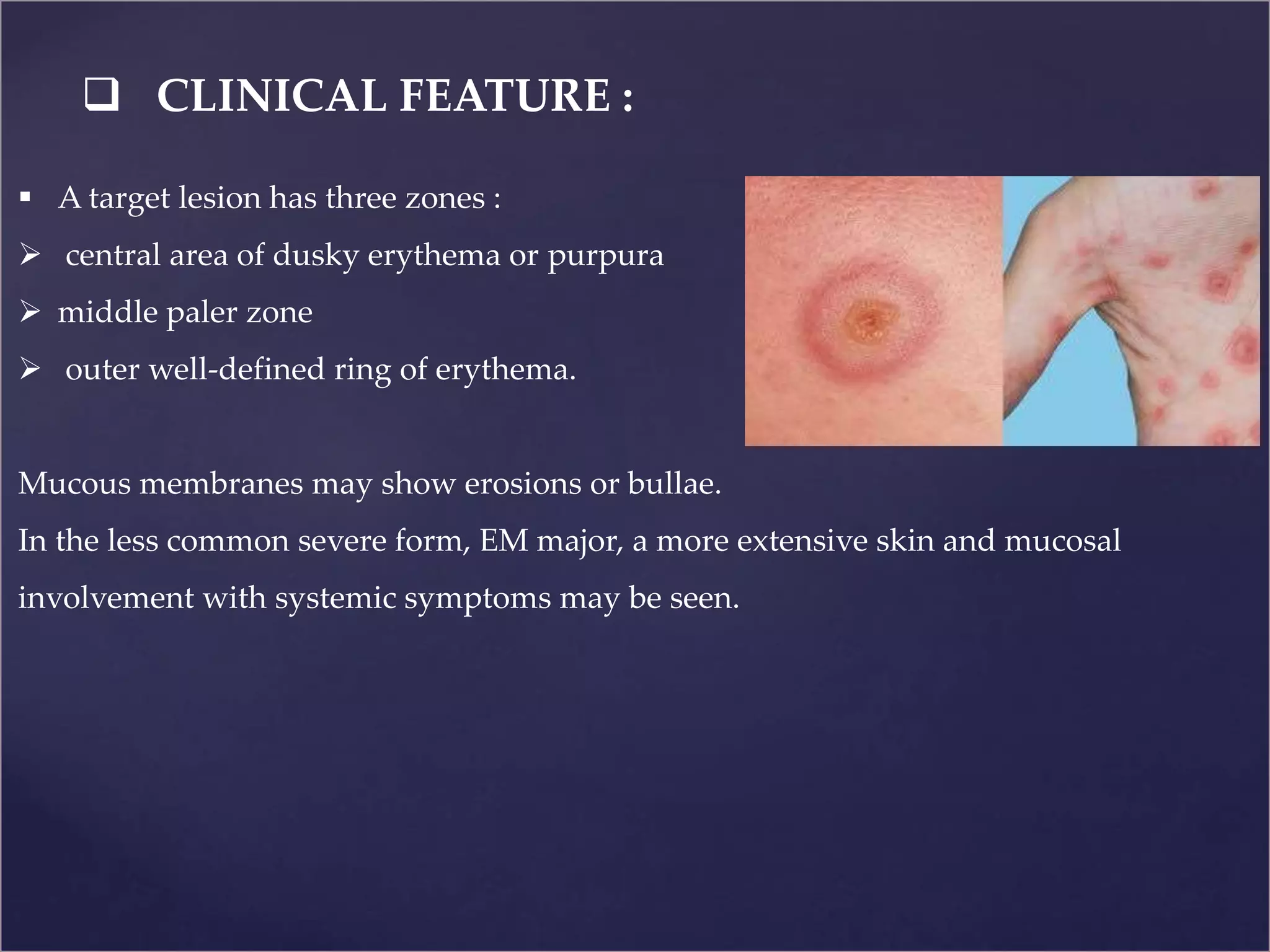 ERYTHEMA MULTIFORME.pptx