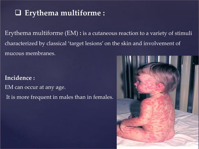 ERYTHEMA MULTIFORME.pptx
