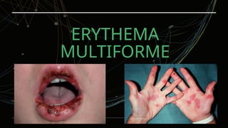 ERYTHEMA MULTIFORME.pptx by department of oral medicine | PPTX | Skin ...