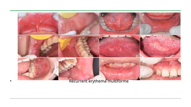 ERYTHEMA MULTIFORME.pptx by department of oral medicine | PPTX | Skin ...