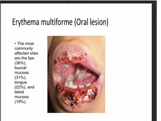 Erythema multiforme; a disease of the oral cavity.pptx A | PPT