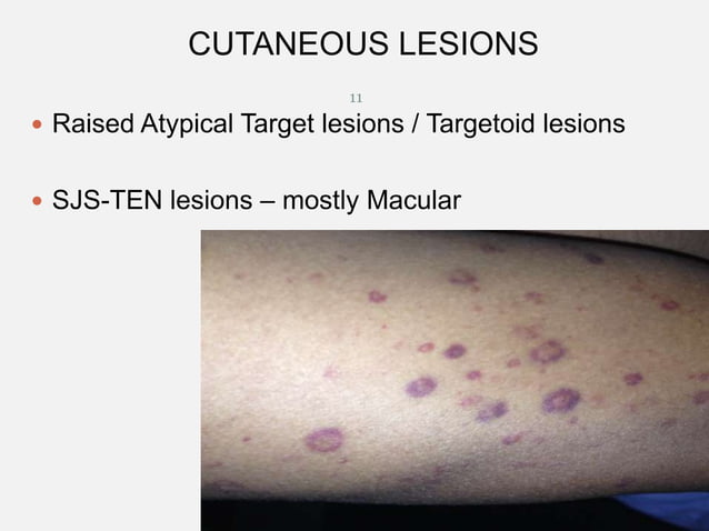 Erythema multiforme by aseem | PPTX | Skin and Dermatology | Diseases ...